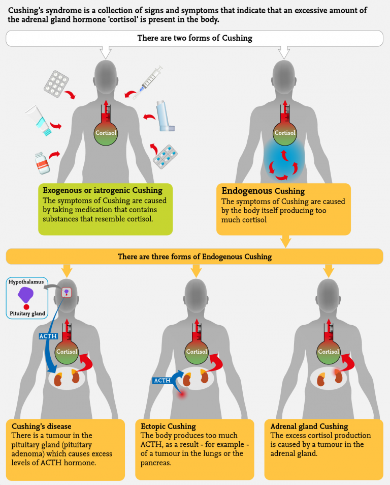 Cushing's syndrome infographic - Adrenals.eu
